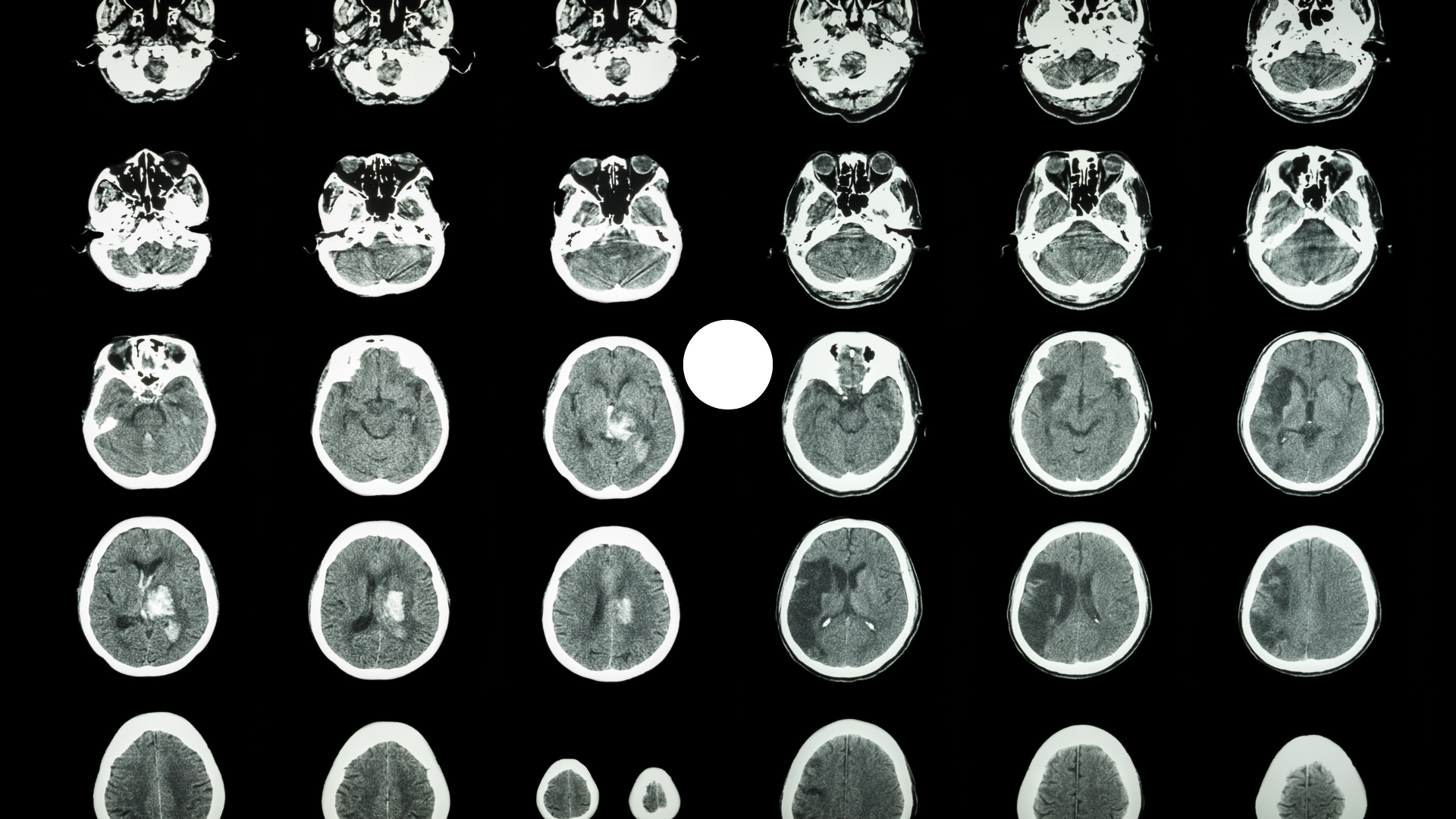 Cada segundo cuenta: la historia de Ana y por qué actuar rápido puede ...